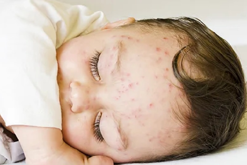 Kenali alergi susu sapi pada bayi dari ringan hingga berat